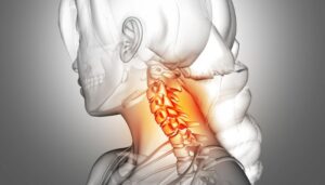 Understanding and Treating Straightening of Cervical Lordosis